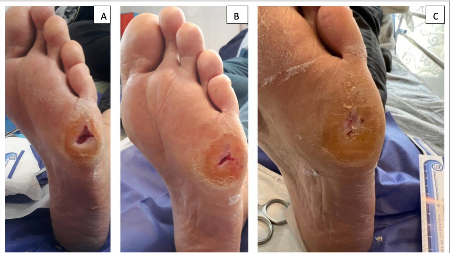 Dry Needling for Neuropathic Diabetic Foot Ulcers - Myopain Seminars